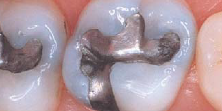 Why you should read this before removing your amalgams? - The ...