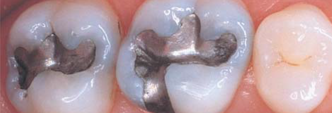 Why you should read this before removing your amalgams? - The ...